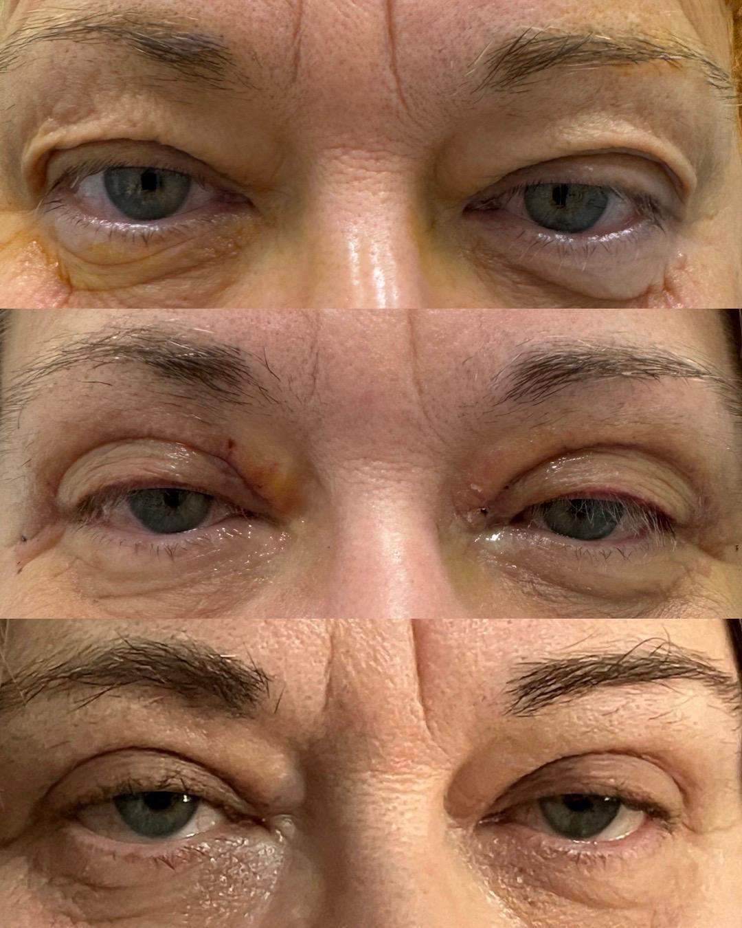 Blefaroplastika vjeđa